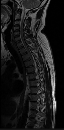 Spine MRI Upper | b-reddy.org
