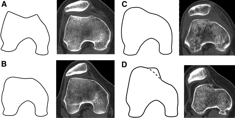 trochlear dysplasia various forms | b-reddy.org