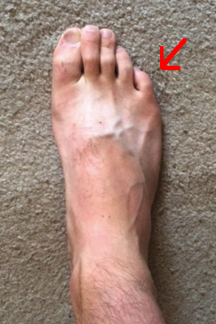 right-foot-toe-in-with-pinky-line | b-reddy.org